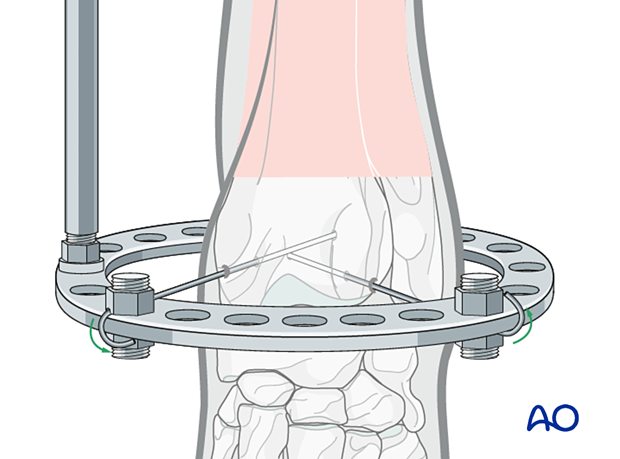 Circular or hybrid external skeletal fixator for Complex fracture of ...