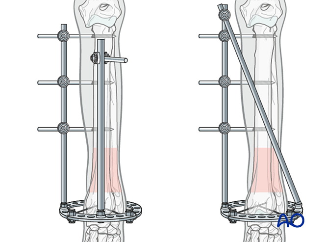 Circular or hybrid external skeletal fixator for Complex fracture of ...