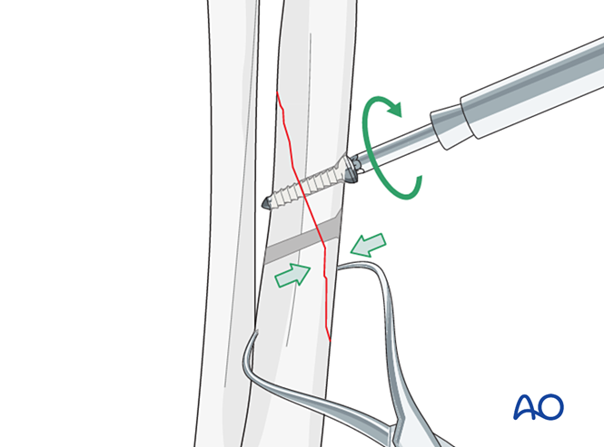 Lag screw fixation