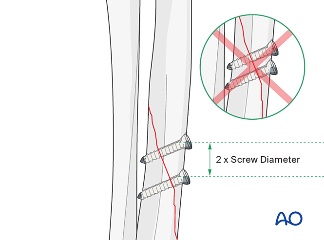 Lag screw fixation