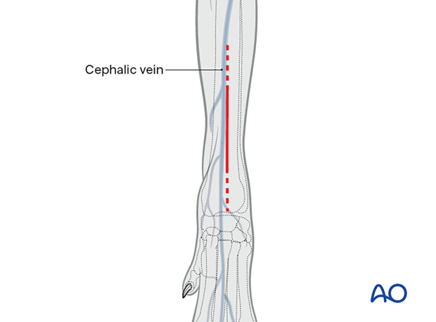 Cranial approach to the distal radius