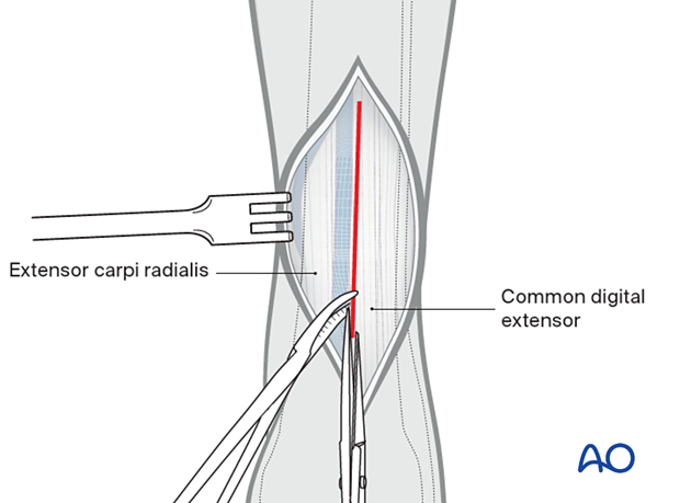 Cranial approach to the distal radius