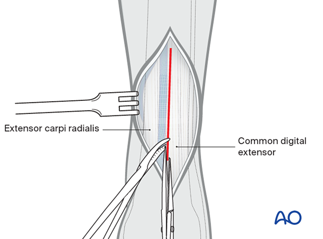 Cranial approach to the distal radius