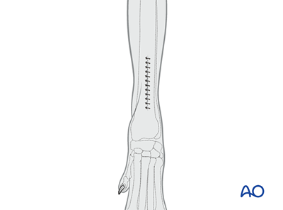 Cranial approach to the distal radius