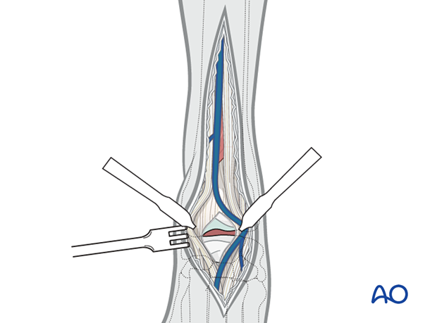 Cranial approach to the distal radius