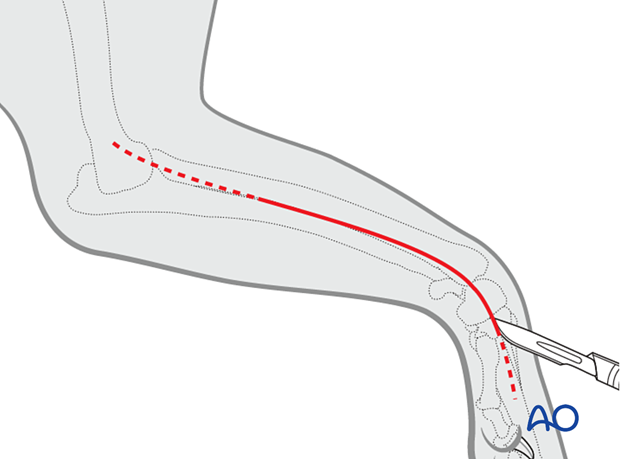 Craniomedial approach to the distal radius