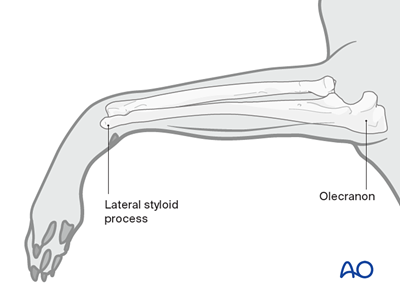 Lateral ulnar approach to the distal radius