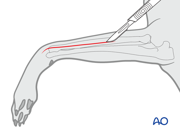 Lateral ulnar approach to the distal radius