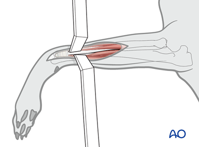Lateral ulnar approach to the distal radius