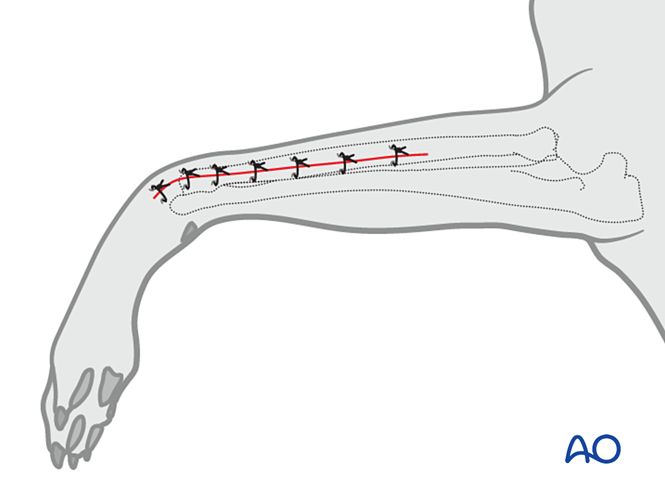 Lateral ulnar approach to the distal radius