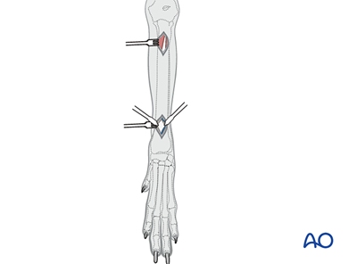 All approaches to the distal radius and ulna