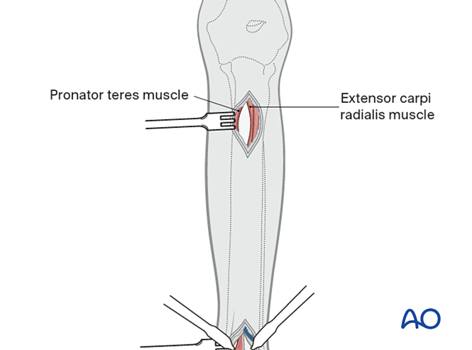 Minimally invasive osteosynthesis approach to the distal radius and ulna