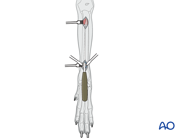 Minimally invasive osteosynthesis approach to the distal radius and ulna
