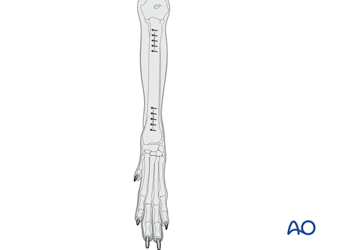 Minimally invasive osteosynthesis approach to the distal radius and ulna