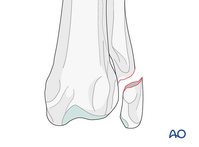 Simple extraarticular fracture of the distal ulna