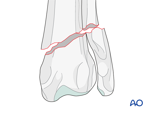 Simple extraarticular fracture of the distal radius
