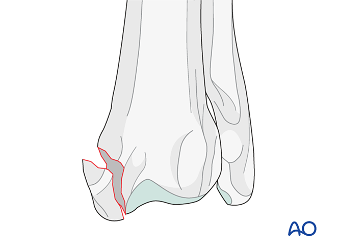 Partial articular sagittal fracture of the distal radius