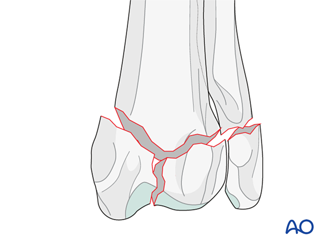 Simple complete articular fracture of the distal radius with associated ...