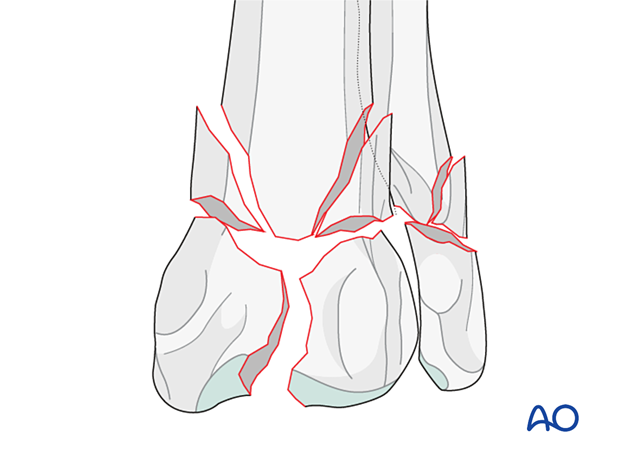 Simple articular, multifragmentary metaphyseal fracture of the distal ...
