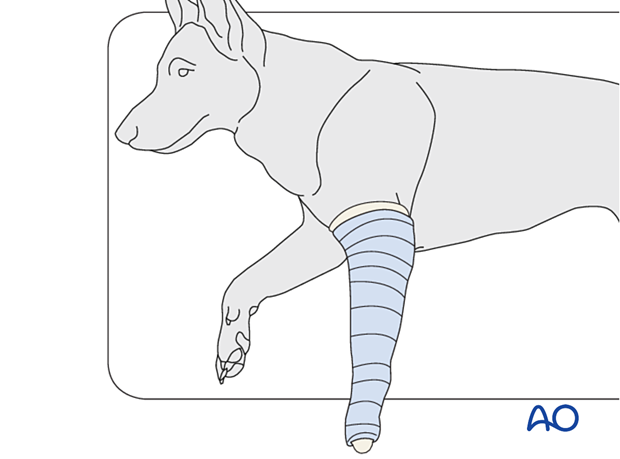 Nonoperative treatment for Simple extraarticular fracture of the distal ...