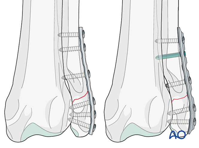 Compression plate fixation for Simple extraarticular fracture of the ...