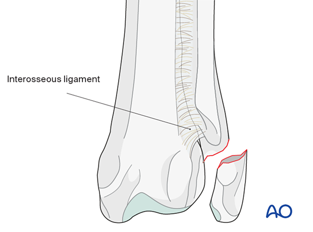 Compression plate fixation for Simple extraarticular fracture of the ...