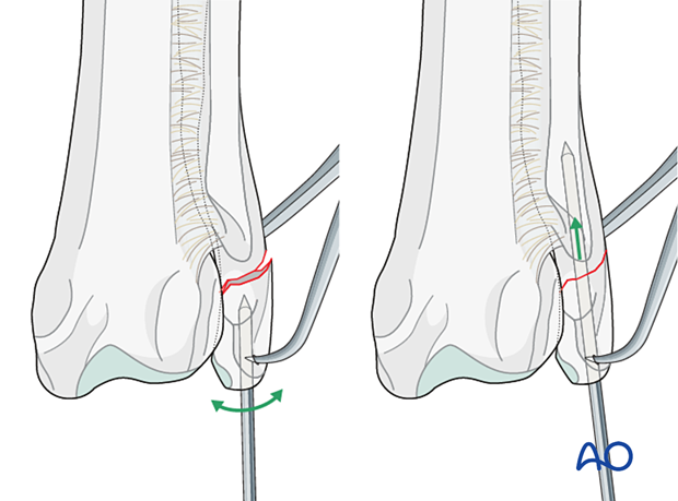 Bridging plate fixation for Simple extraarticular fracture of the ...