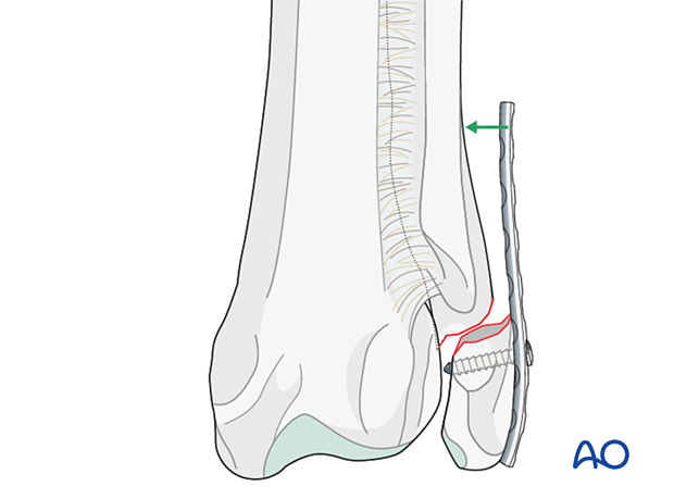 Compression plate fixation for Simple extraarticular fracture of the ...