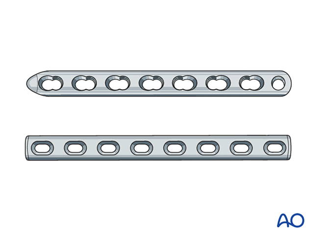 Compression plate fixation for Simple extraarticular fracture of the ...