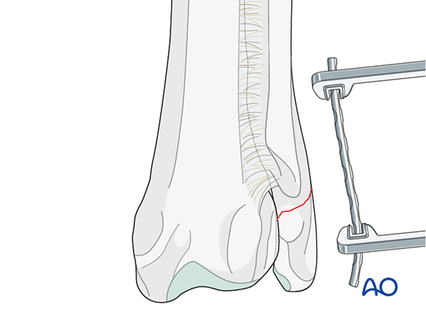 Compression plate fixation for Simple extraarticular fracture of the ...