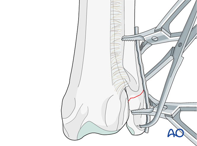 Compression plate fixation for Simple extraarticular fracture of the ...
