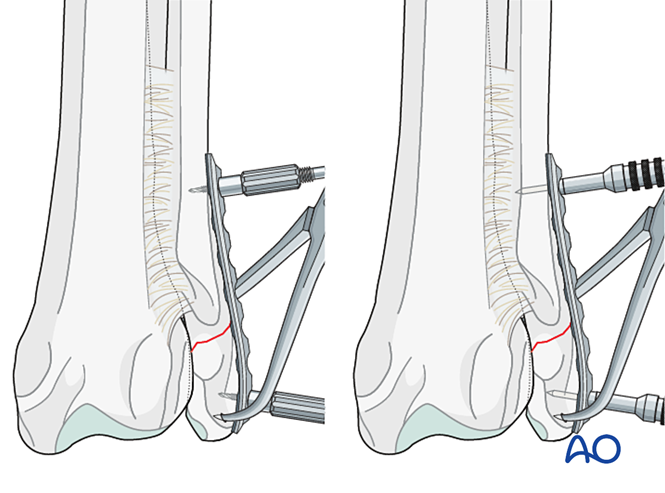 Compression plate fixation for Simple extraarticular fracture of the ...