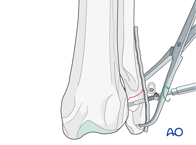 Compression plate fixation for Simple extraarticular fracture of the ...