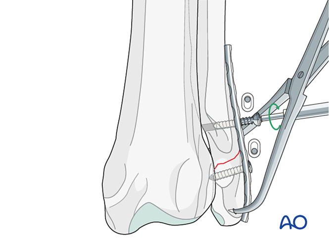 Compression plate fixation for Simple extraarticular fracture of the ...