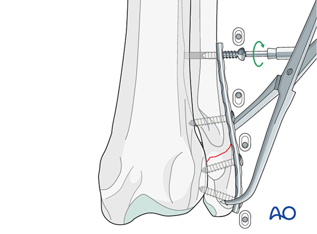 Compression plate fixation for Simple extraarticular fracture of the ...