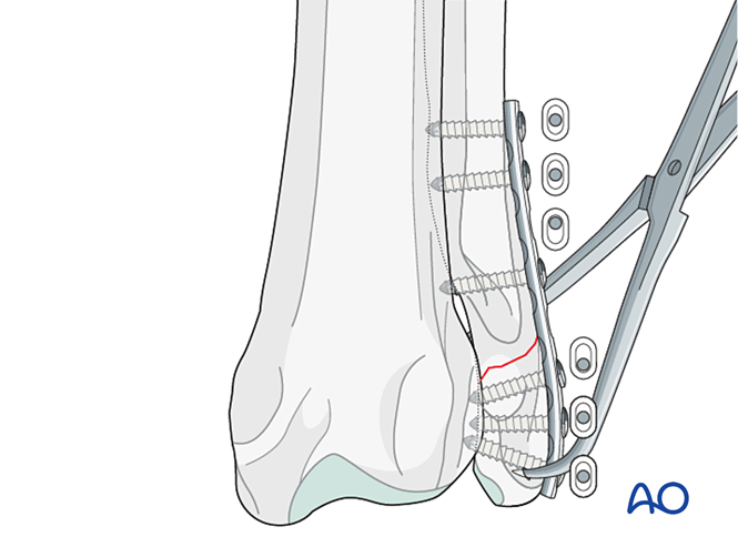 Compression plate fixation for Simple extraarticular fracture of the ...