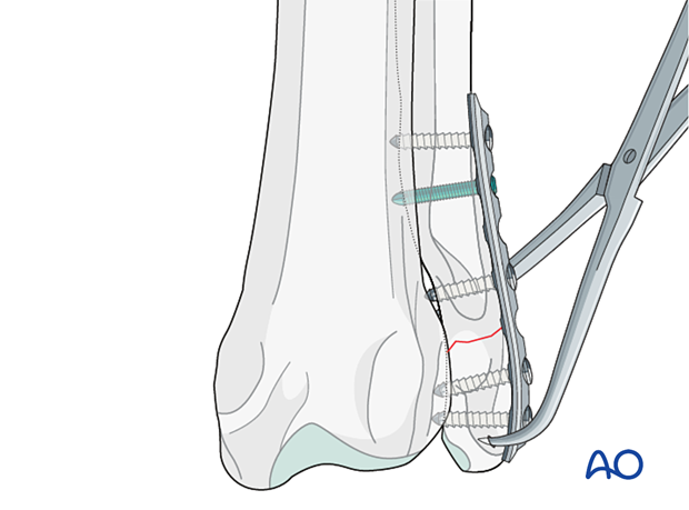 Compression plate fixation for Simple extraarticular fracture of the ...