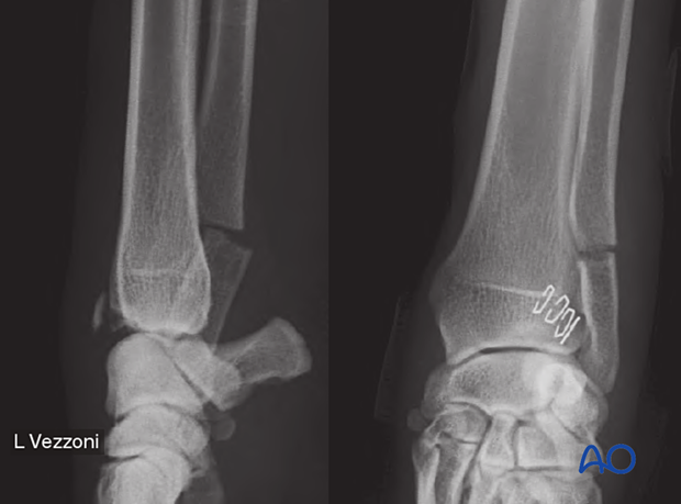 Compression plate fixation for Simple extraarticular fracture of the ...