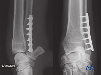 Compression plate fixation for Simple extraarticular fracture of the ...