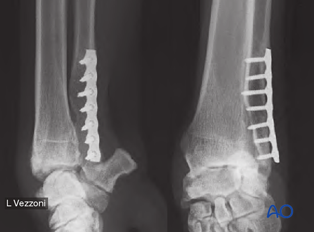 Compression plate fixation for Simple extraarticular fracture of the ...