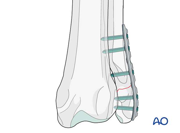 Bridging plate fixation for Simple extraarticular fracture of the ...