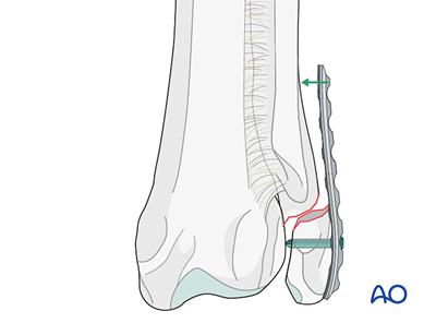 Bridging plate fixation for Simple extraarticular fracture of the ...