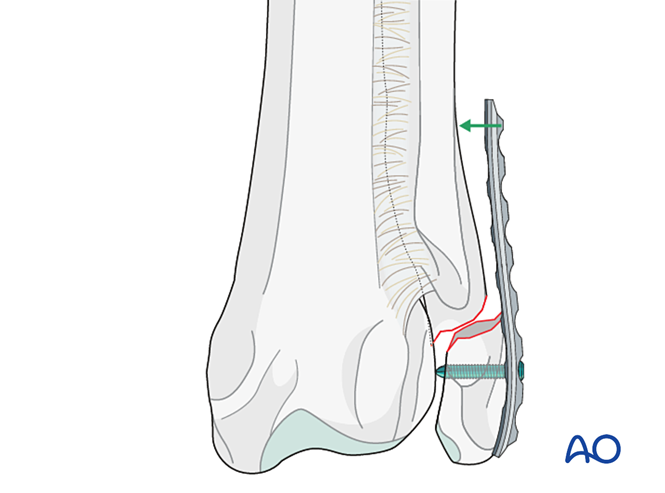 Bridging plate fixation for Simple extraarticular fracture of the ...