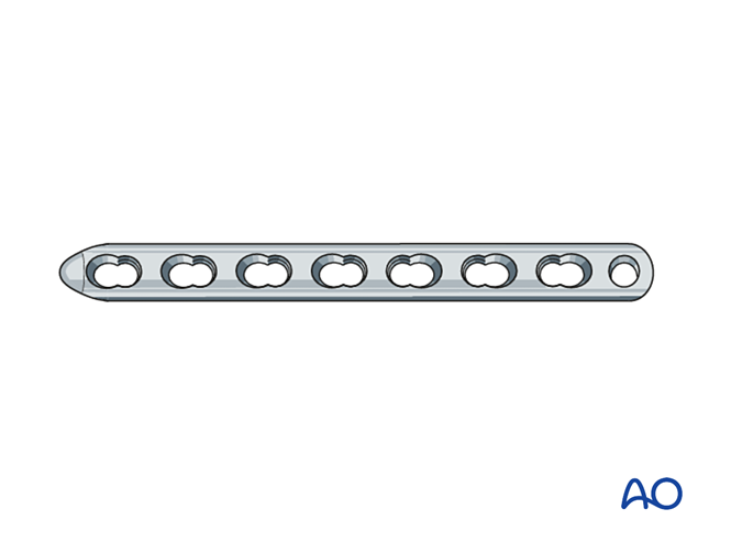 Bridging plate fixation for Simple extraarticular fracture of the ...