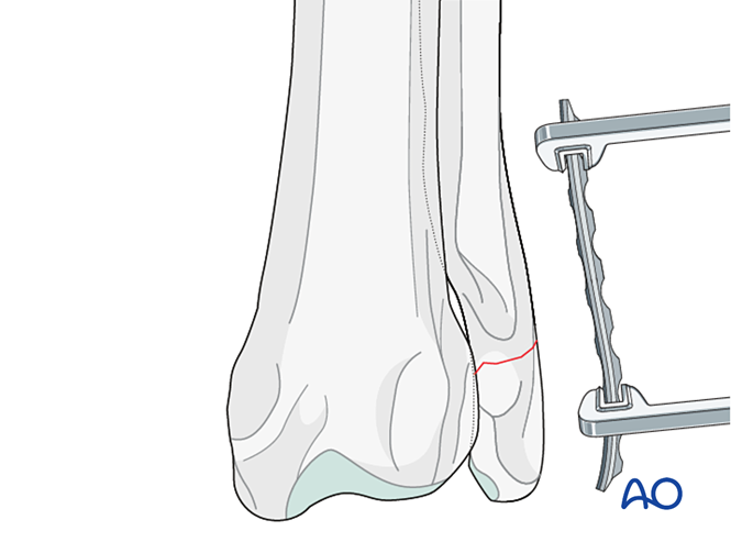 Bridging plate fixation for Simple extraarticular fracture of the ...