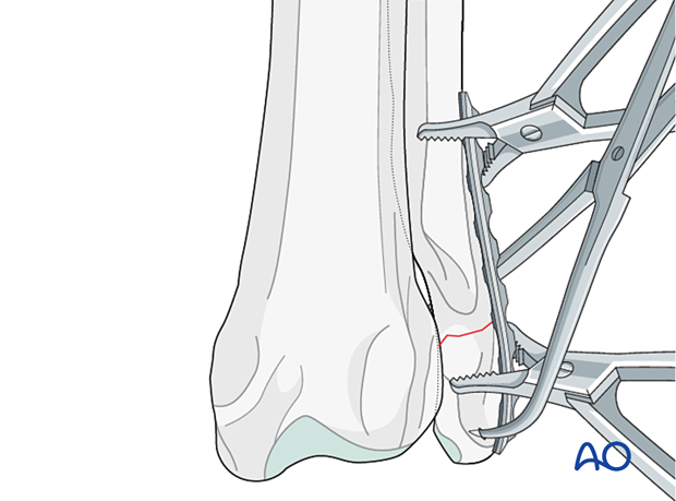Bridging plate fixation for Simple extraarticular fracture of the ...