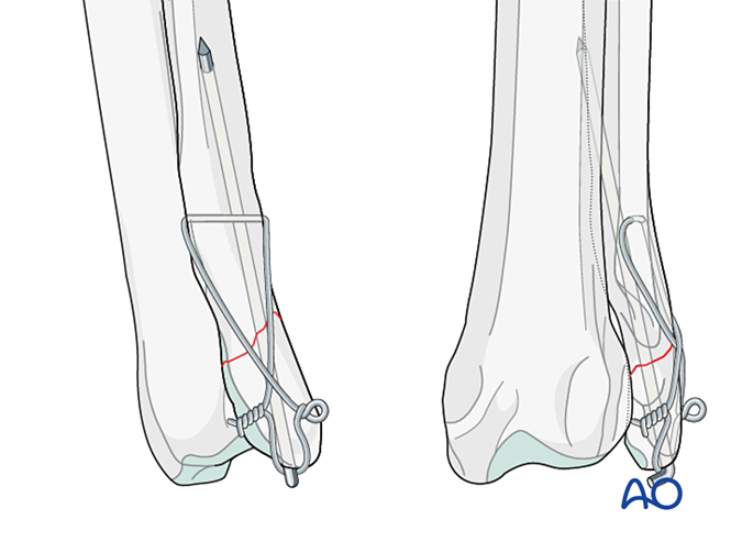 K-wire with or without tension band for Simple extraarticular fracture ...
