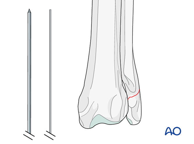 K-wire with or without tension band for Simple extraarticular fracture ...
