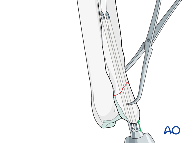 K-wire with or without tension band for Simple extraarticular fracture ...