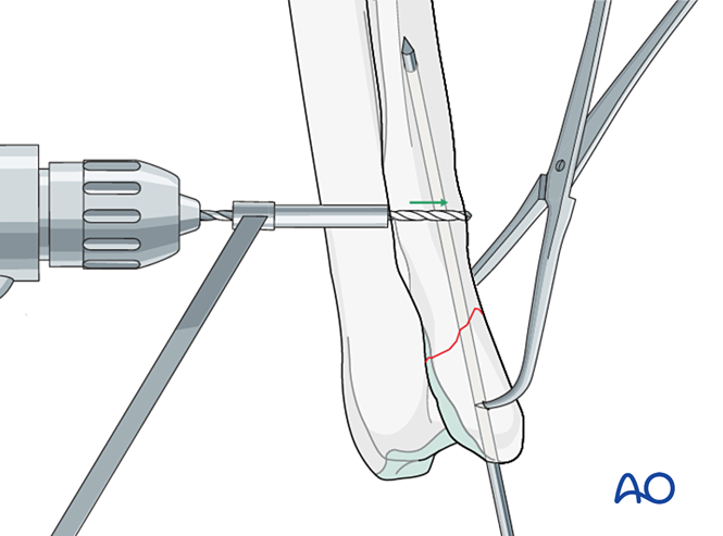 K-wire with or without tension band for Simple extraarticular fracture ...